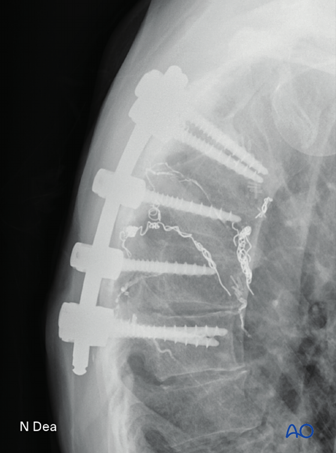 En bloc resection of a posterior tumor (T1 to T12) for Malignant ...