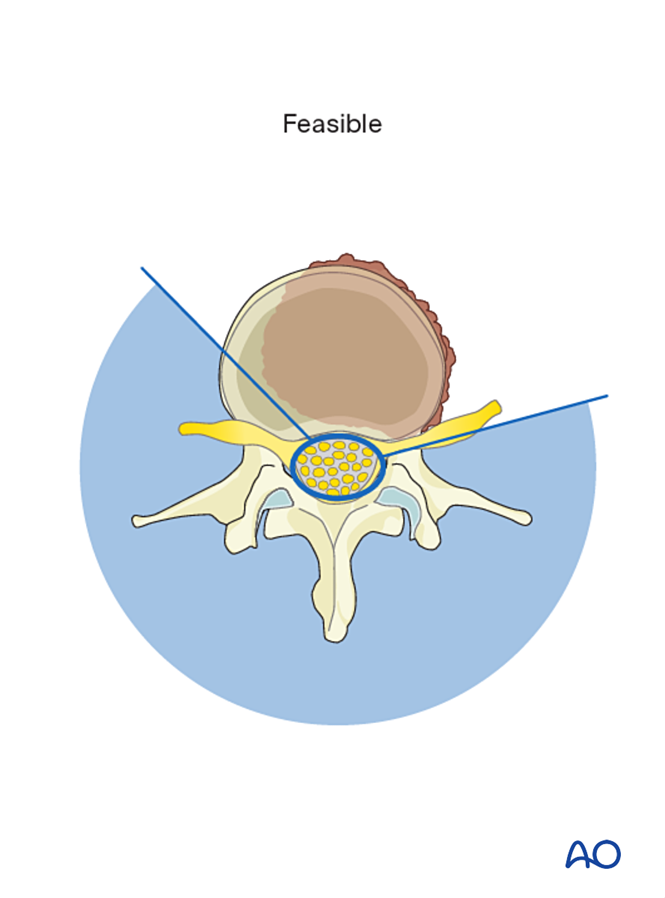 En bloc resection with posterior release and anterior tumor delivery ...