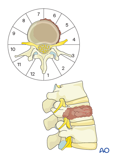 En bloc resection with posterior release and anterior tumor delivery ...