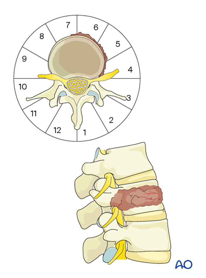 En bloc resection with posterior release and anterior tumor delivery ...