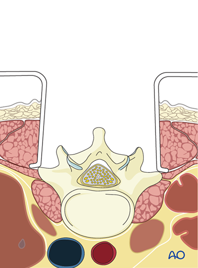 En bloc resection with posterior release and anterior tumor delivery ...