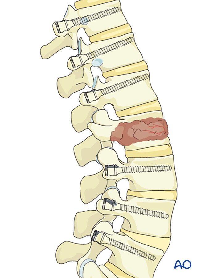 En bloc resection with posterior release and anterior tumor delivery ...
