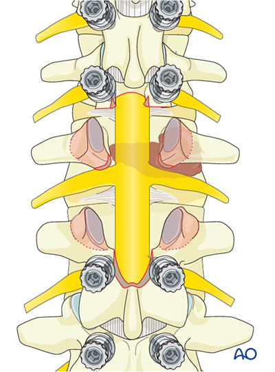 En bloc resection with posterior release and anterior tumor delivery ...
