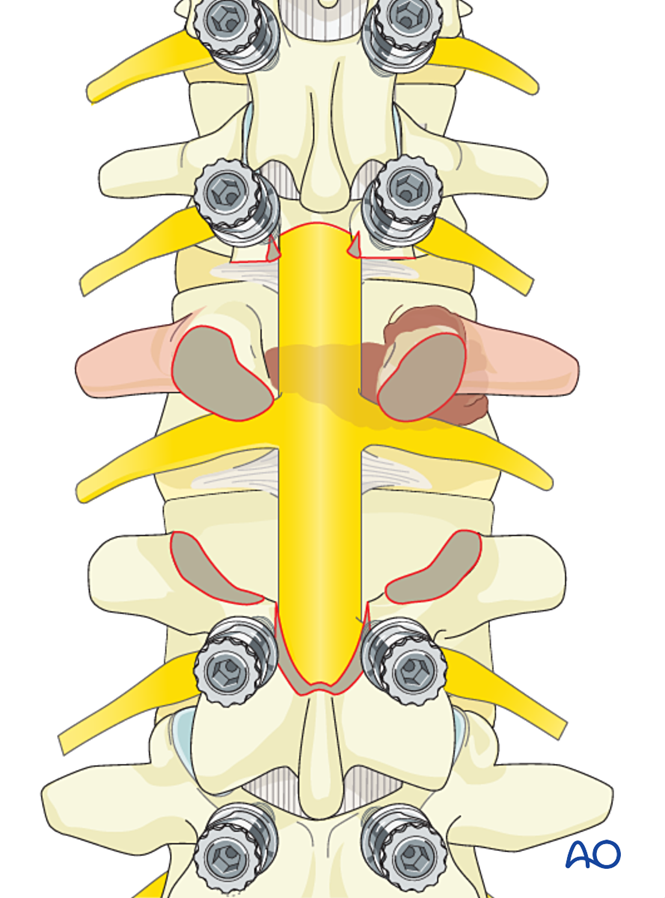 En bloc resection with posterior release and anterior tumor delivery ...