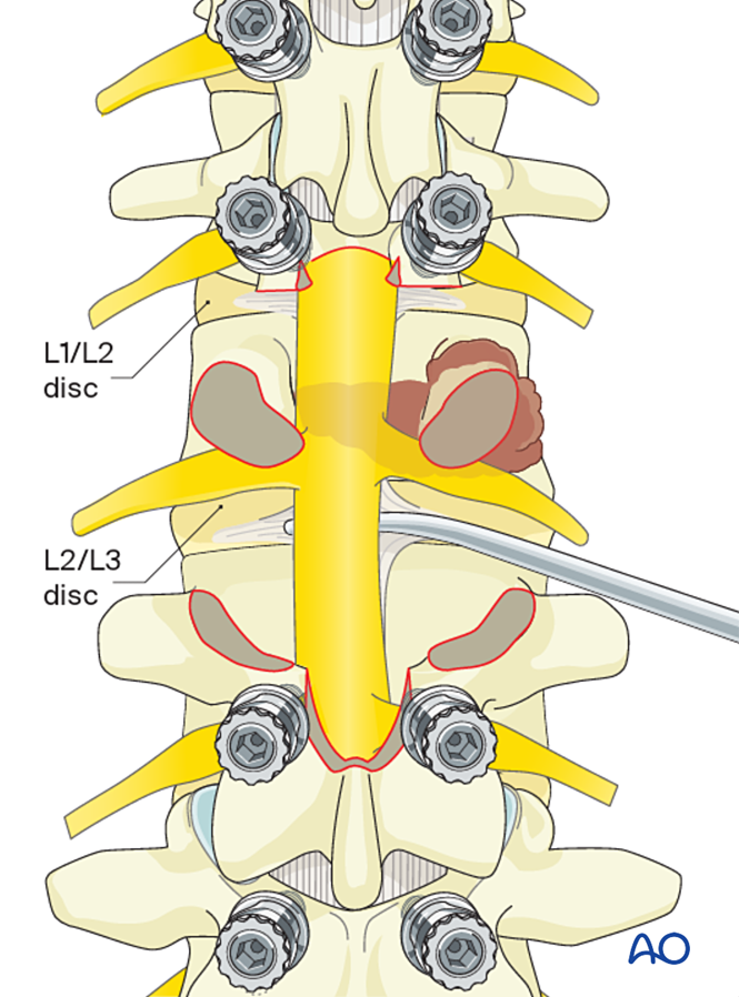 En bloc resection with posterior release and anterior tumor delivery ...