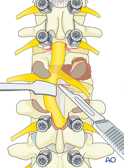 En bloc resection with posterior release and anterior tumor delivery ...
