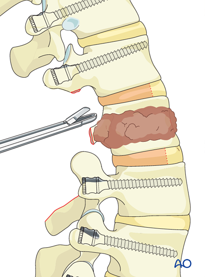 En bloc resection with posterior release and anterior tumor delivery ...