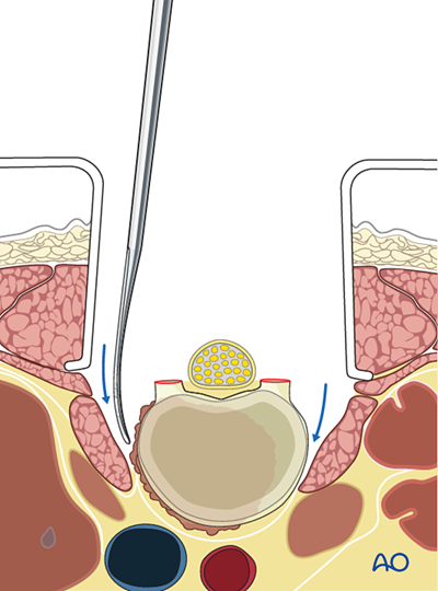 En bloc resection with posterior release and anterior tumor delivery ...
