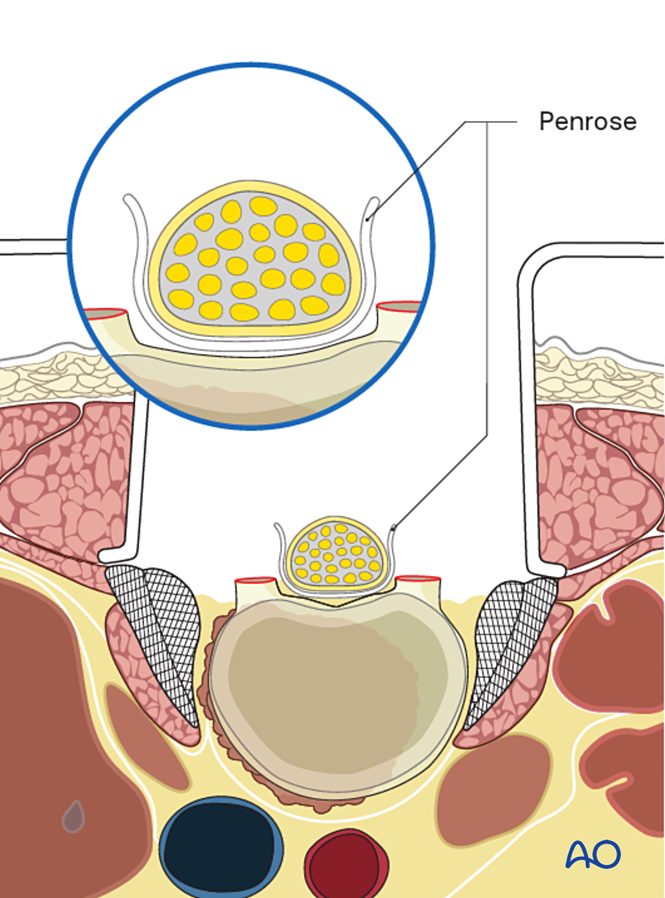En bloc resection with posterior release and anterior tumor delivery ...