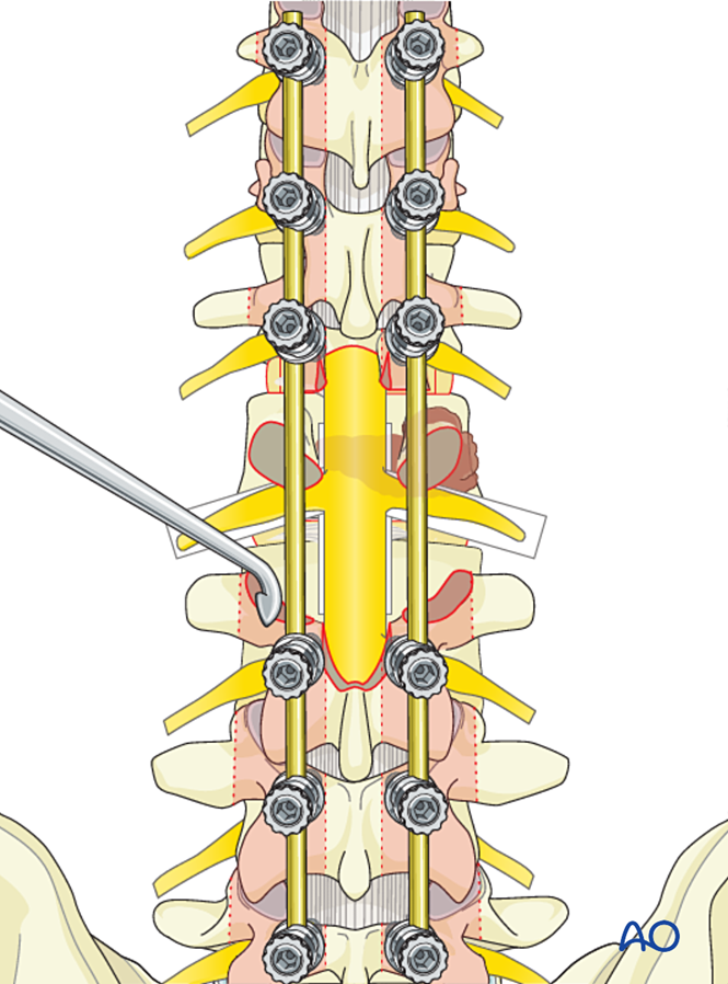 En bloc resection with posterior release and anterior tumor delivery ...