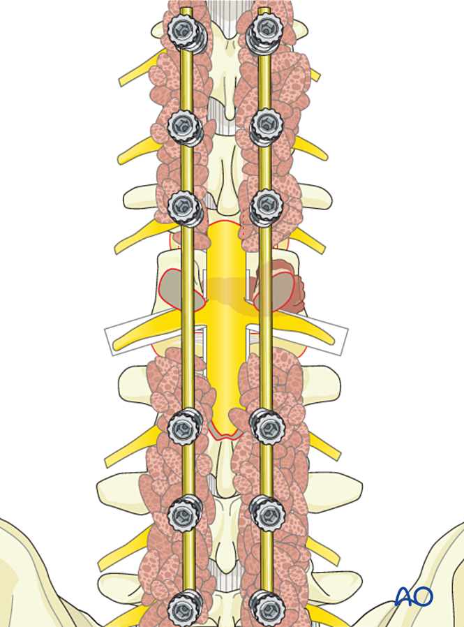 En bloc resection with posterior release and anterior tumor delivery ...
