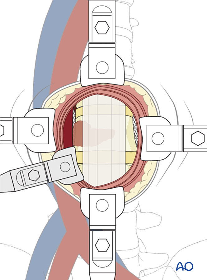 En bloc resection with posterior release and anterior tumor delivery ...