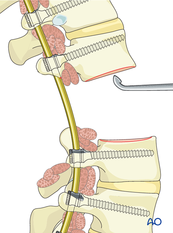 En bloc resection with posterior release and anterior tumor delivery ...