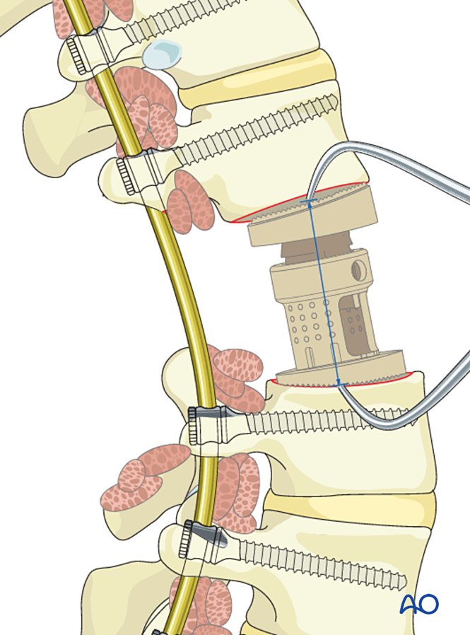 En bloc resection with posterior release and anterior tumor delivery ...