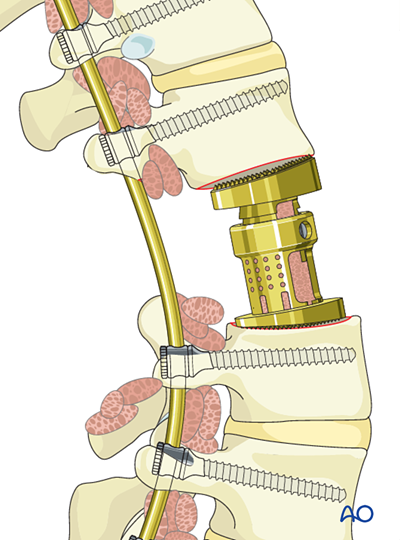 En bloc resection with posterior release and anterior tumor delivery ...