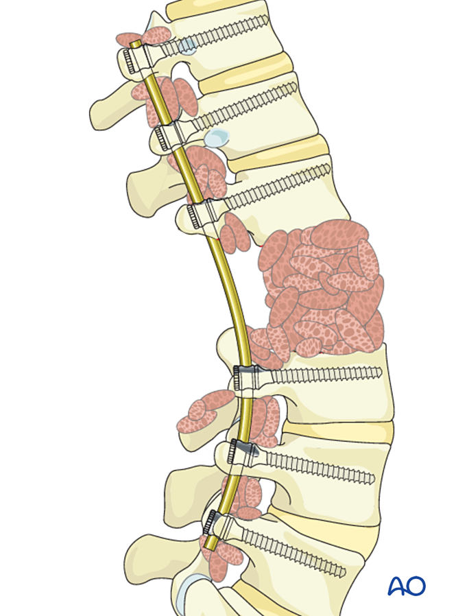 En bloc resection with posterior release and anterior tumor delivery ...