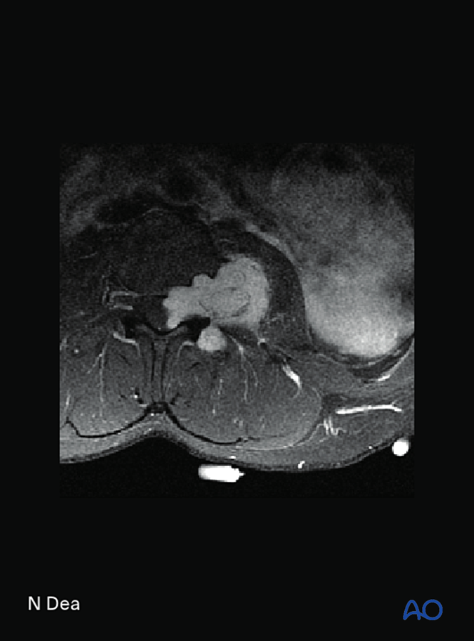 En bloc resection of a posterior tumor (L1 to L5) for Malignant lumbar ...