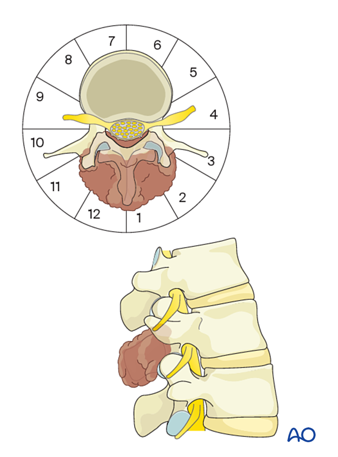 En bloc resection of a posterior tumor (L1 to L5) for Malignant lumbar ...