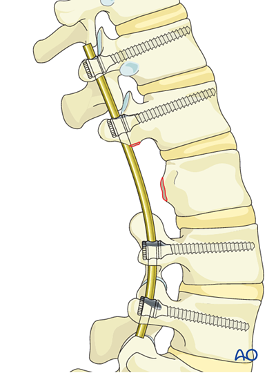 En bloc resection of a posterior tumor (L1 to L5) for Malignant lumbar ...