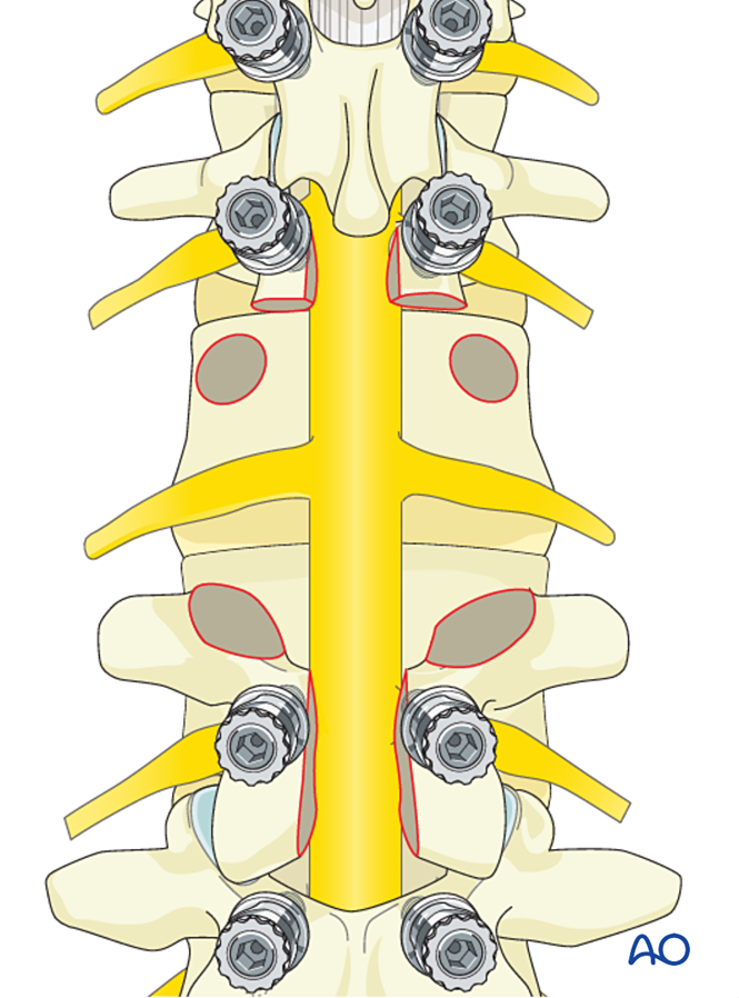 En bloc resection of a posterior tumor (L1 to L5) for Malignant lumbar ...