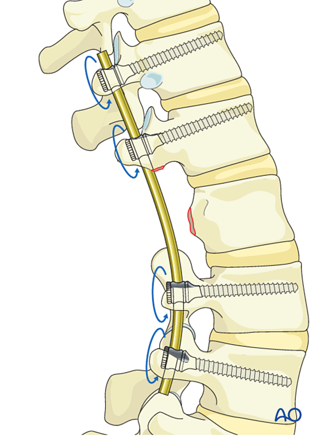 En bloc resection of a posterior tumor (L1 to L5) for Malignant lumbar ...