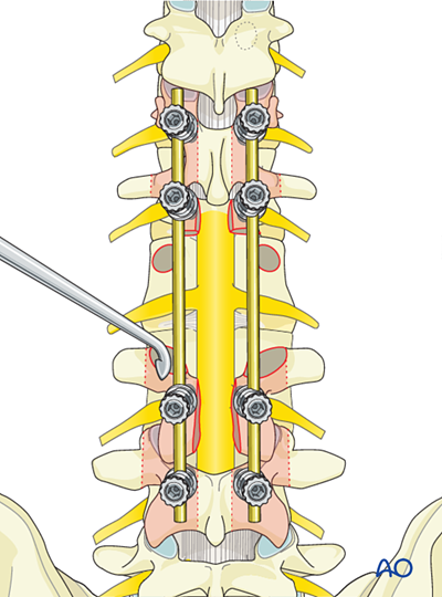 En bloc resection of a posterior tumor (L1 to L5) for Malignant lumbar ...