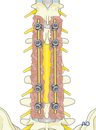 En bloc resection of a posterior tumor (L1 to L5) for Malignant lumbar ...