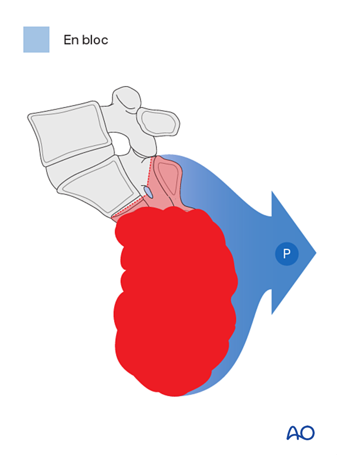 En bloc resection (S1 to S2) for Benign sacral tumors