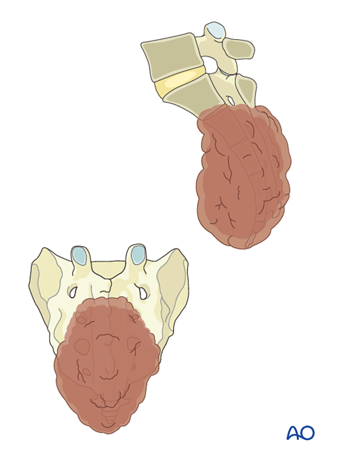 En bloc resection (S1 to S2) for Benign sacral tumors