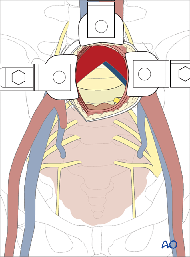 En bloc resection (S1 to S2) for Benign sacral tumors