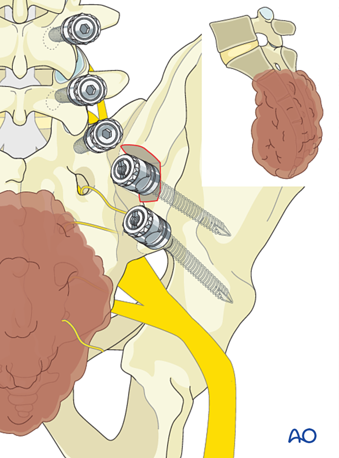 En bloc resection (S1–S2) for Malignant sacral tumors