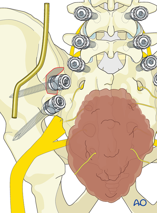 En bloc resection (S1 to S2) for Benign sacral tumors