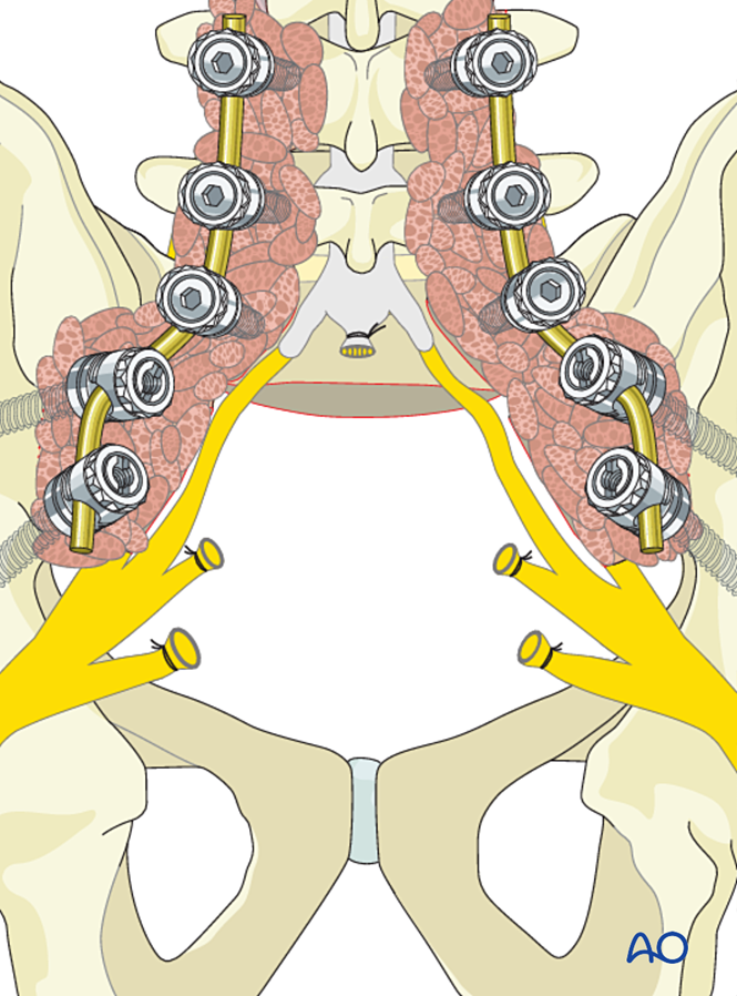 En bloc resection (S1–S2) for Malignant sacral tumors