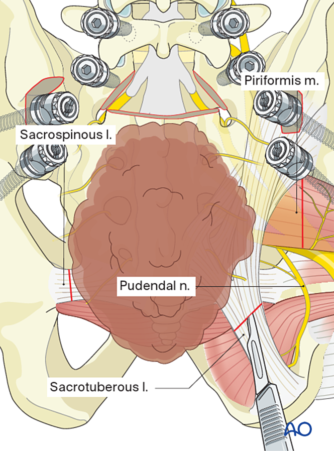 En bloc resection (S1 to S2) for Benign sacral tumors