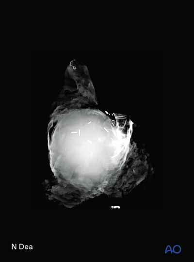 En bloc resection (S1–S2) for Malignant sacral tumors