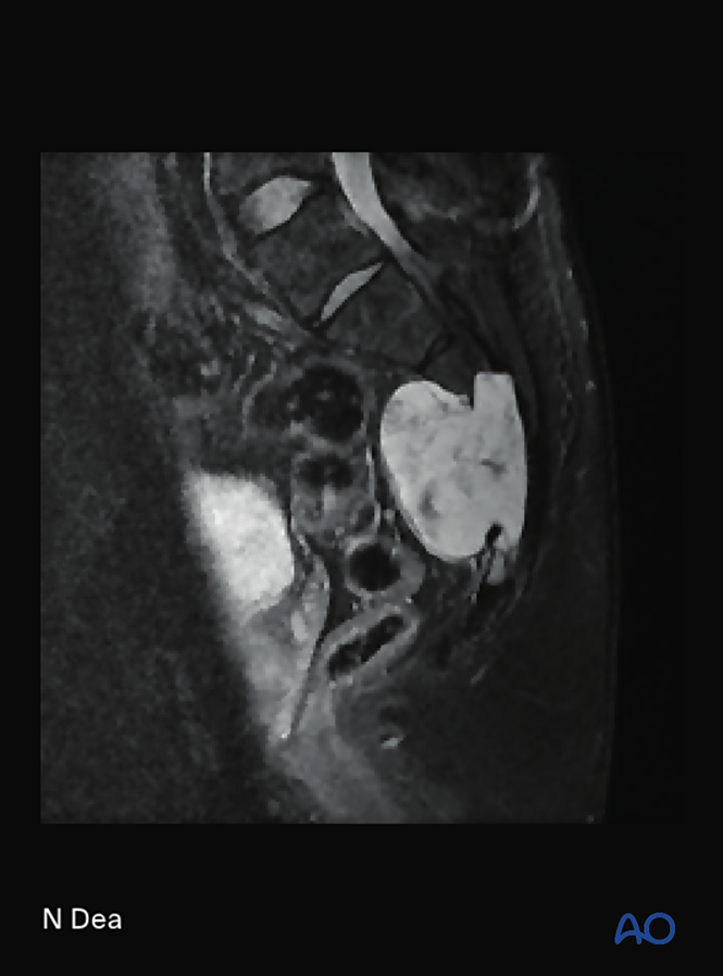 En Bloc Resection S3 To S5 For Malignant Sacral Tumors