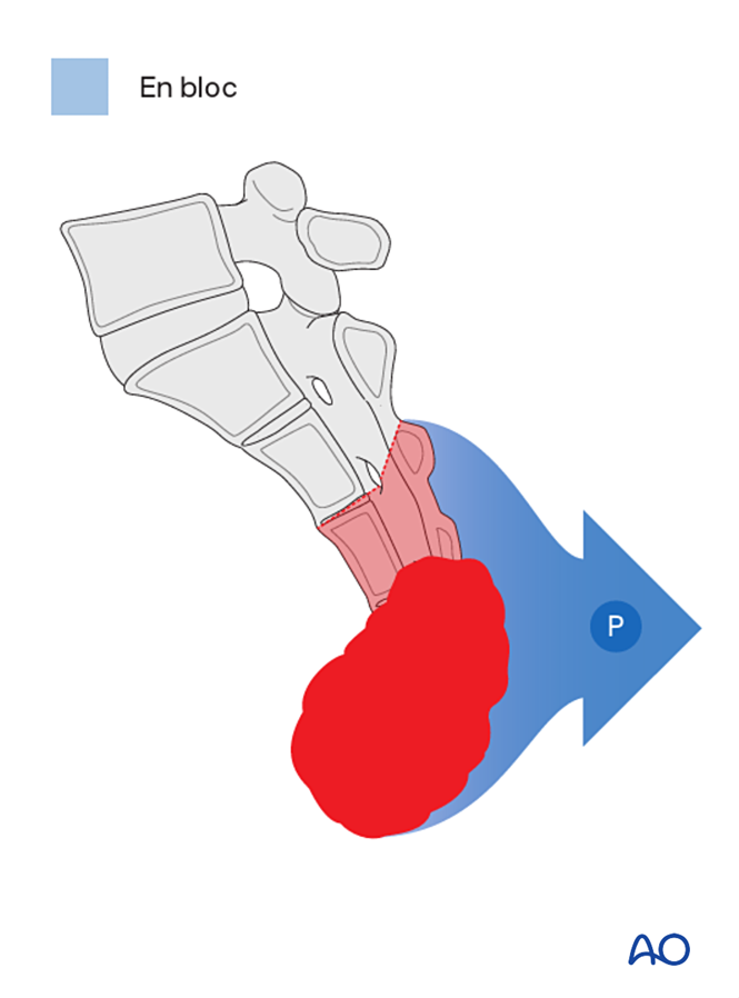 En bloc resection (S3 to S5) for Benign sacral tumors