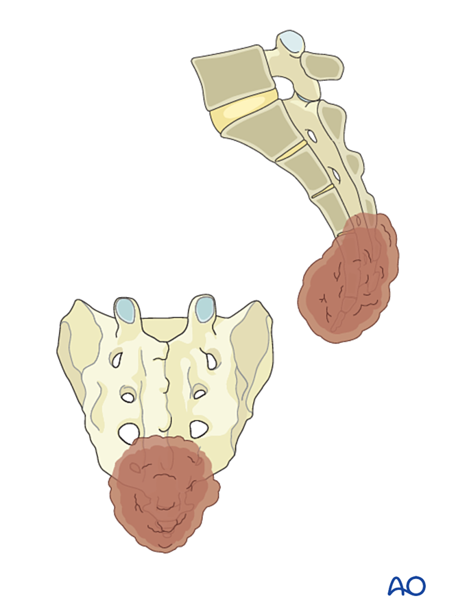 En bloc resection (S3 to S5) for Malignant sacral tumors