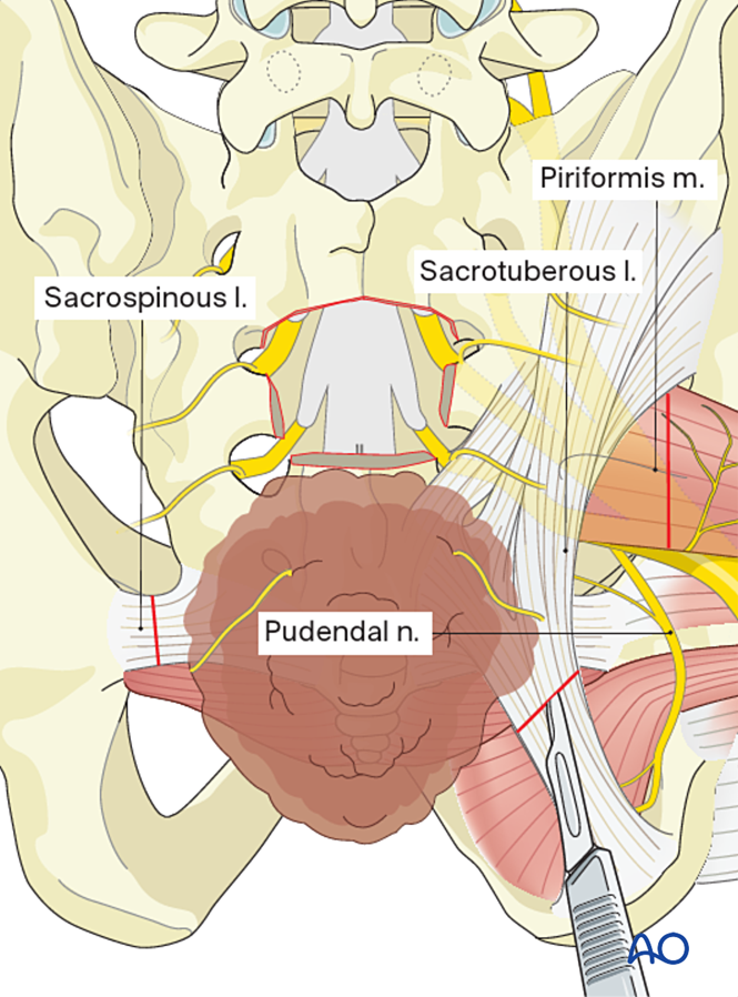 En bloc resection (S3 to S5) for Benign sacral tumors
