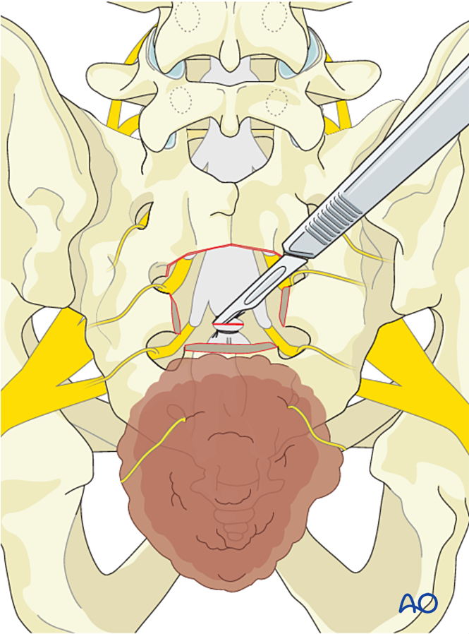 En bloc resection (S3 to S5) for Benign sacral tumors