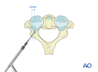 C2 pedicle screw insertion