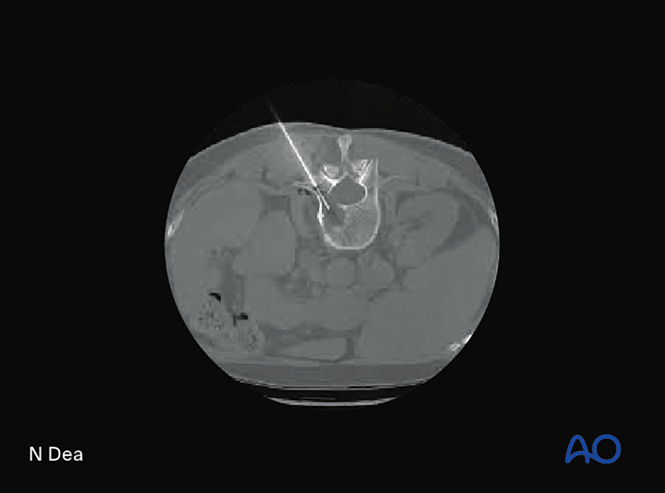 Suspected primary spine tumors: essential initial assessment