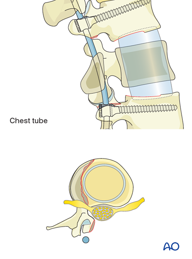 PMMA application for vertebral body reconstruction