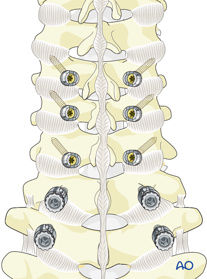 Lateral mass screw insertion (Magerl technique)