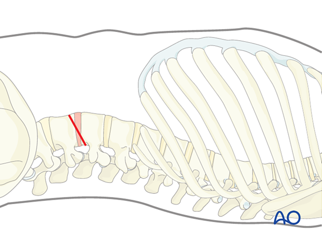 Lateral lumbar interbody fusion (LLIF) for Degenerative spondylolisthesis