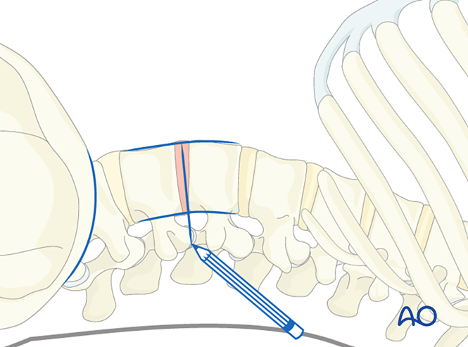 Minimally invasive transpsoas approach (L2–L4)