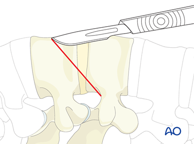 Minimally invasive transpsoas approach (L2–L4)