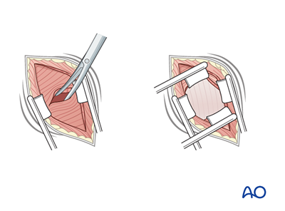 Minimally invasive transpsoas approach (L2–L4)