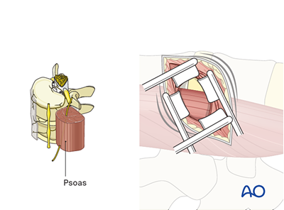 Minimally invasive transpsoas approach (L2–L4)