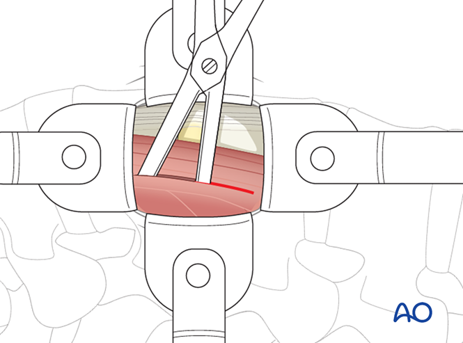 Minimally invasive transpsoas approach (L2–L4)